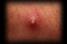 Heat Boils: What They Mean & How to Treat Them