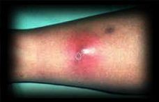 Heat Boils: What They Mean & How to Treat Them