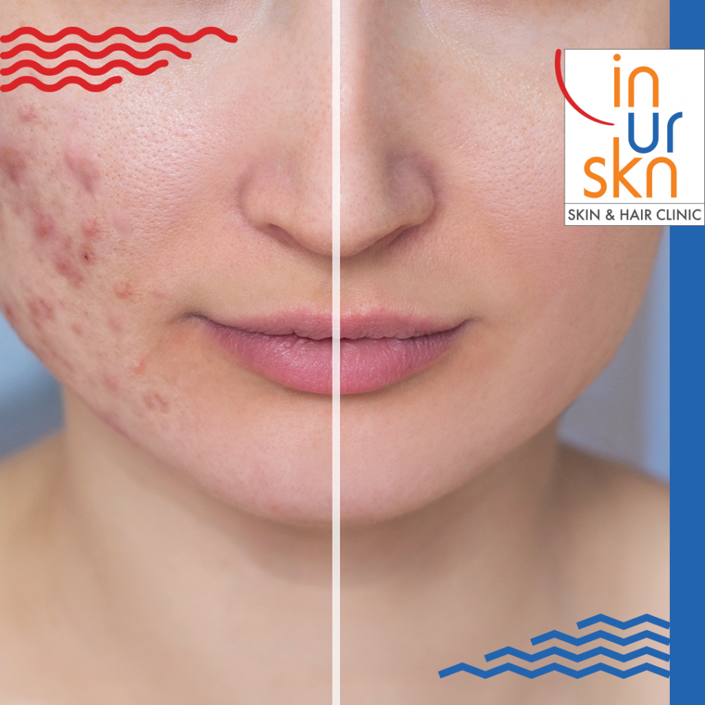 Your guide to a blemish free skin post acne breakouts - inurskn