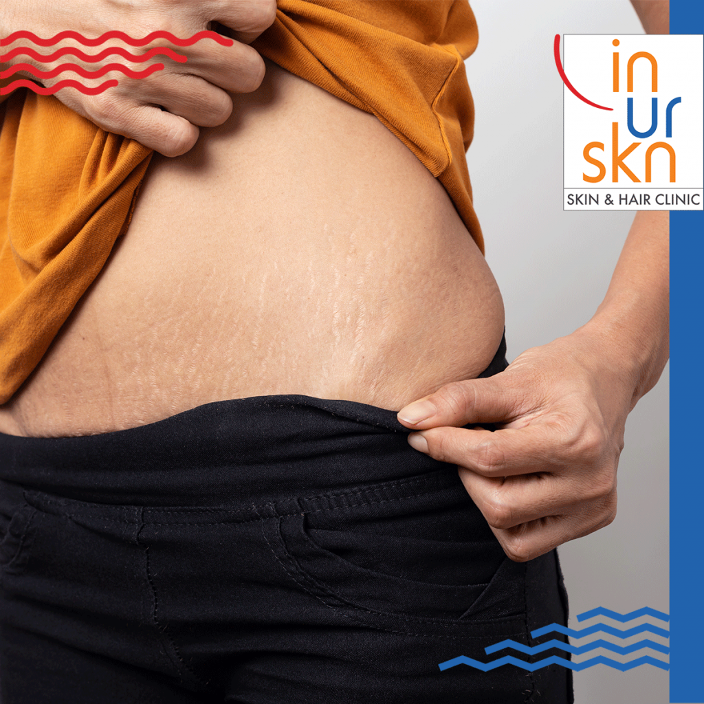 Scars & Stretch Marks: Causes and Treatments