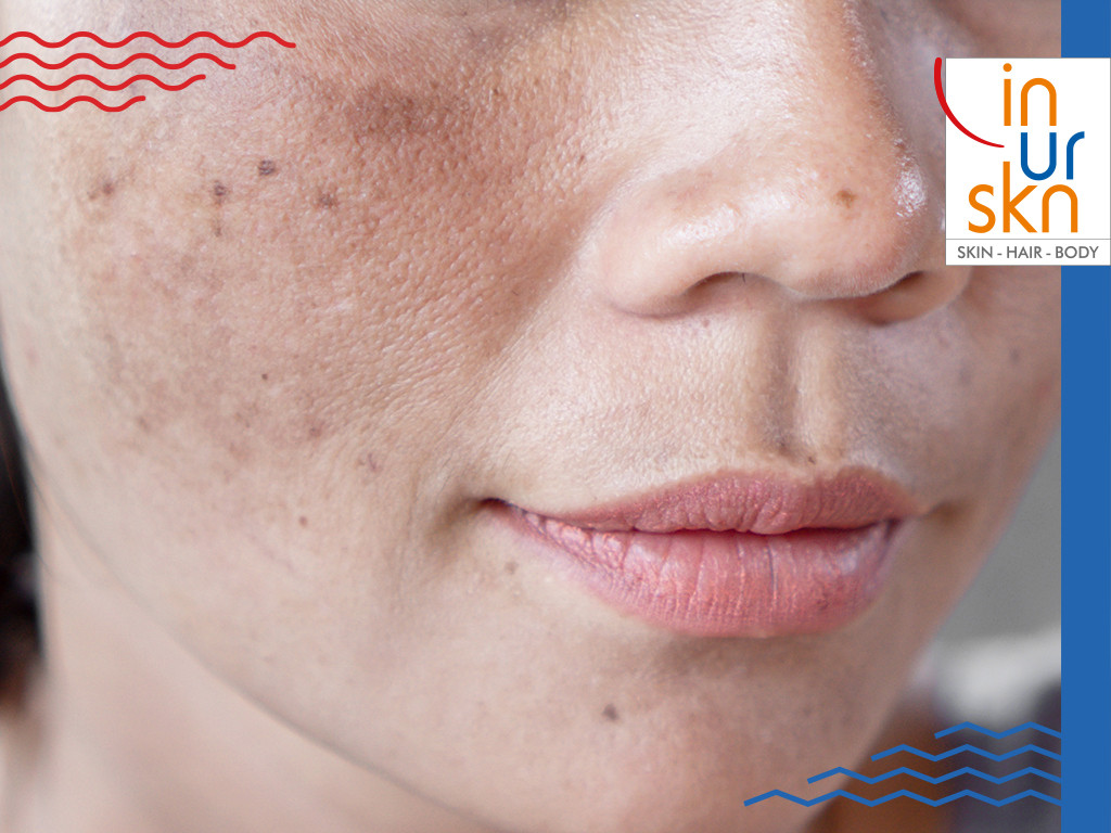 All You Need to Know About Melasma- From an Expert Dermatologist - inurskn